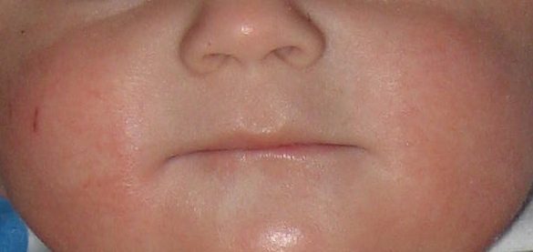 Ampollitas que pican en manos y pies: dishidrosis o ponfólix