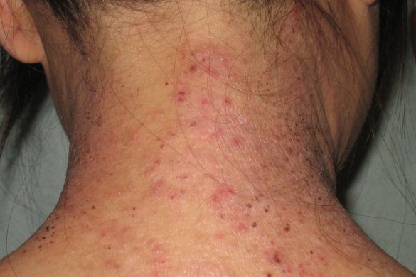 Urticaria: picor y ronchas que vienen y van - Dra. LOREA BAGAZGOITIA