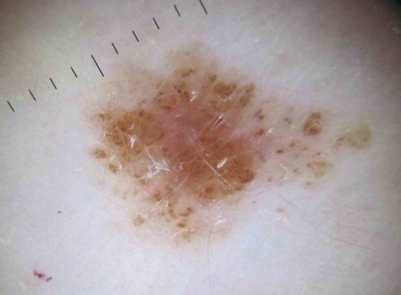 nevus dermatoscopia - Dra. LOREA BAGAZGOITIA