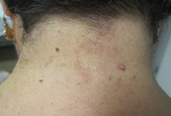 Tratamiento de los fibromas o acrocordones - Dra. LOREA BAGAZGOITIA