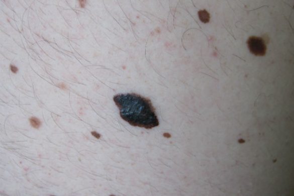 Manchas marrones y rugosas por el cuerpo - Dra. LOREA BAGAZGOITIA