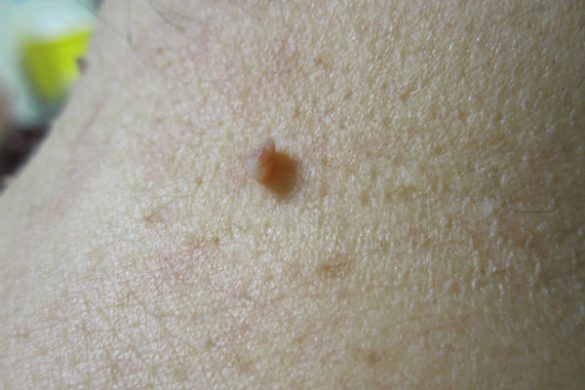 ¿Qué son los fibromas o acrocordones? - Dra. LOREA BAGAZGOITIA