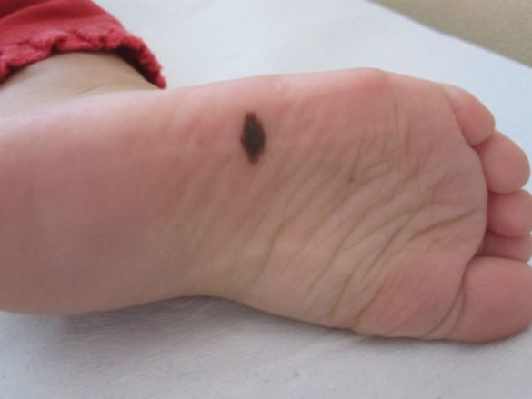 Moles on the feet and hands - Dra. LOREA BAGAZGOITIA
