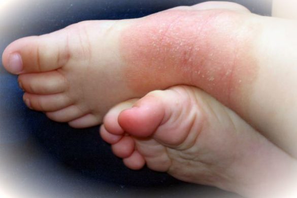 Ampollitas que pican en manos y pies: dishidrosis o ponfólix