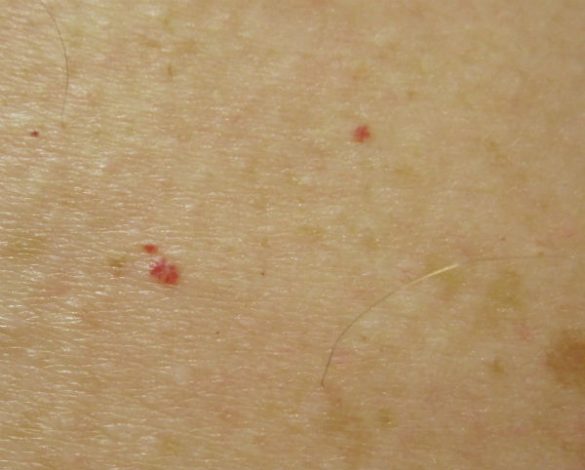 Puntos rubí: bolitas rojas en el cuerpo - Dra. LOREA BAGAZGOITIA