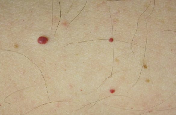 Puntos rubí: bolitas rojas en el cuerpo - Dra. LOREA BAGAZGOITIA