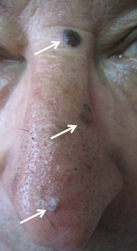 Basal cell carcinoma: 4 features of the most common skin cancer - Dra ...