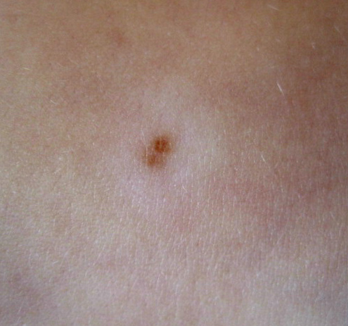 Halo nevus: vanishing moles - Dra. LOREA BAGAZGOITIA