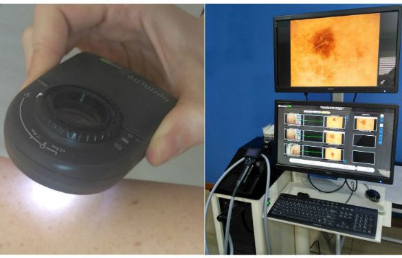 Diagnóstico precoz del melanoma – regla ABCDE - Dra. LOREA BAGAZGOITIA