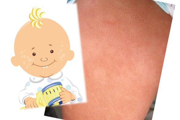 Ampollitas que pican en manos y pies: dishidrosis o ponfólix