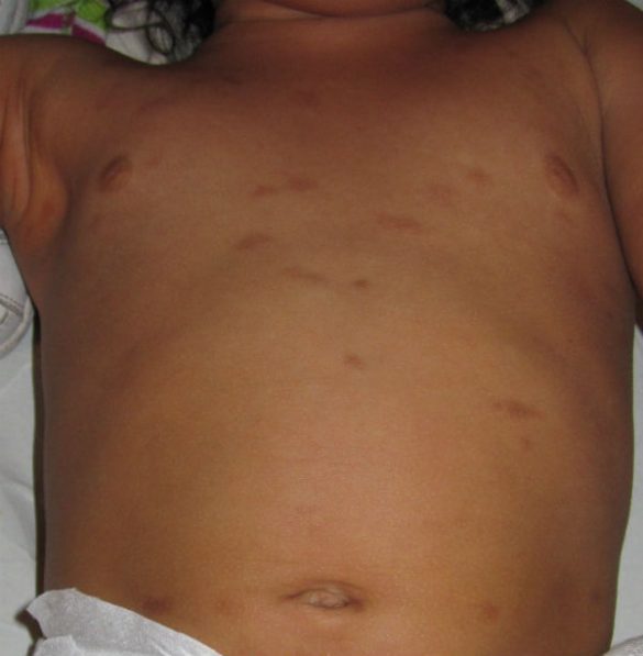 MASTOCITOSIS EN LOS NIÑOS - Dra. LOREA BAGAZGOITIA