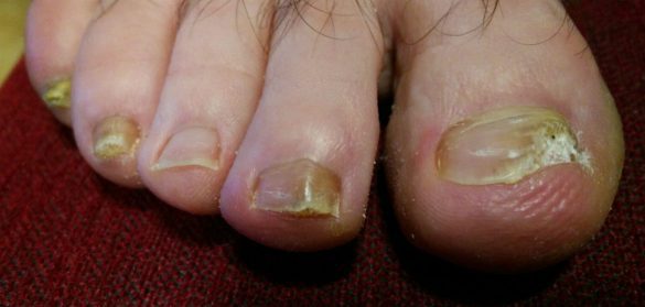 Onicomicosis: hongos en las uñas de los pies - Dra. LOREA BAGAZGOITIA