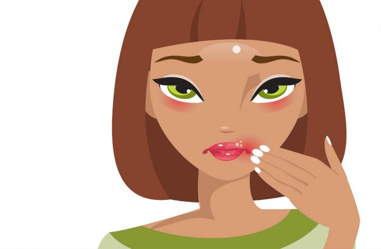 Calenturas o herpes labiales, ¿por qué aparecen? | Doctora Lorea ...