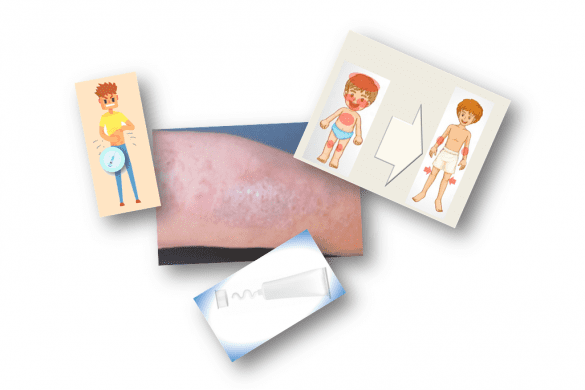 Ampollitas que pican en manos y pies: dishidrosis o ponfólix