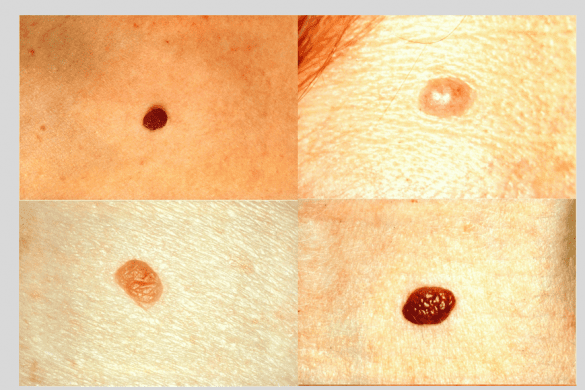 Nevus melanocíticos congénitos (lunares de nacimiento) - Dra. LOREA ...