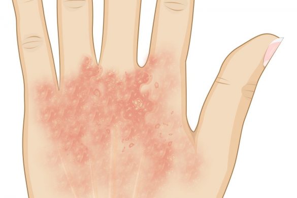 Ampollitas que pican en manos y pies: dishidrosis o ponfólix