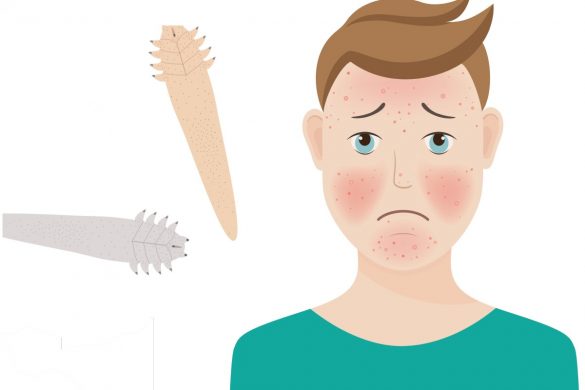 Protopic®(tacrolimus) y Elidel® (pimecrólimus) para la dermatitis ...