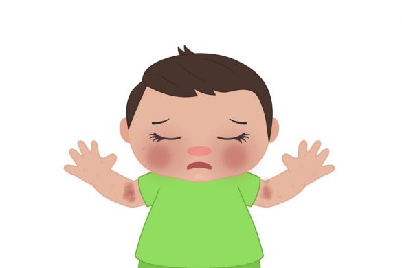 Ampollitas que pican en manos y pies: dishidrosis o ponfólix