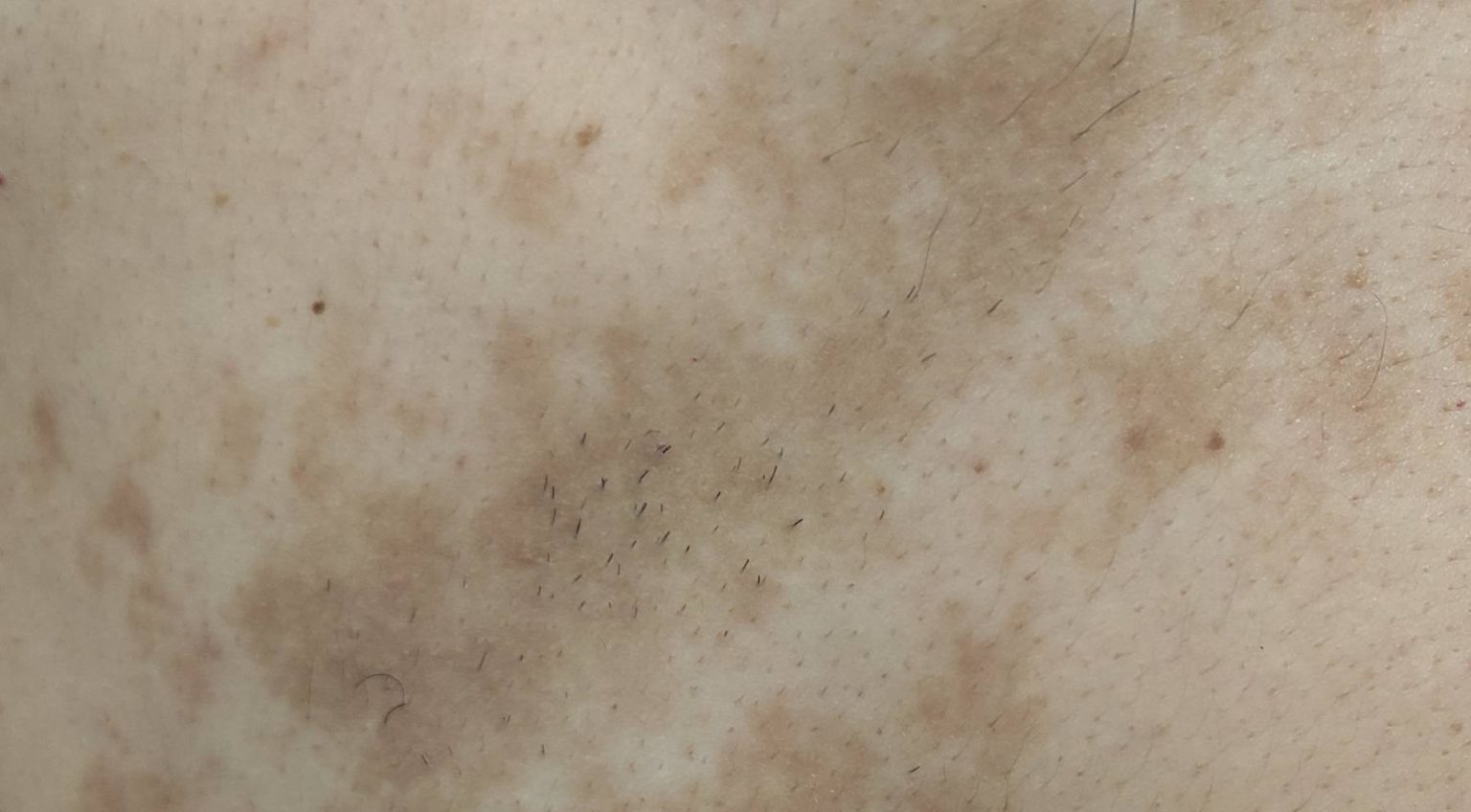 Mancha marrón en la espalda con pelo - Dra. LOREA BAGAZGOITIA