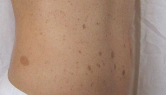 ¿Qué son las manchas café con leche? - Dra. LOREA BAGAZGOITIA