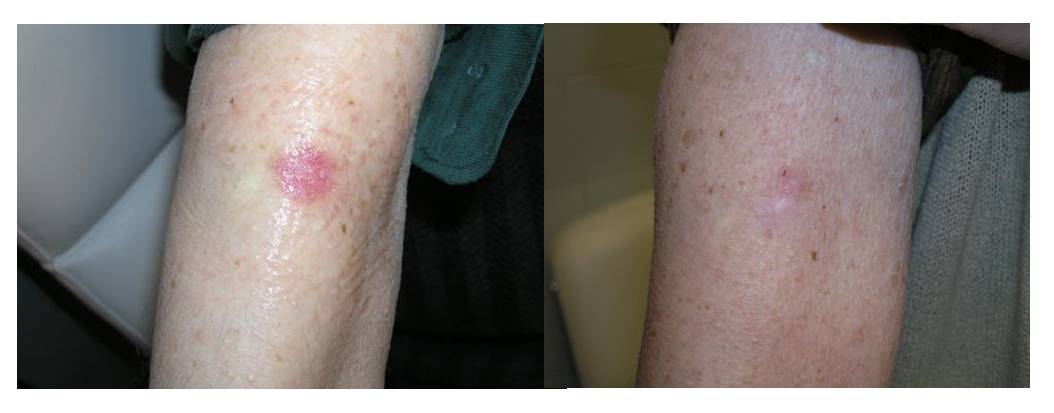 Carcinoma basocelular superficial: el cáncer de piel más «light» - Dra ...