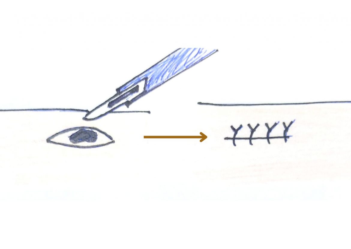 ¿Cómo se extirpan los lunares? - Dra. LOREA BAGAZGOITIA