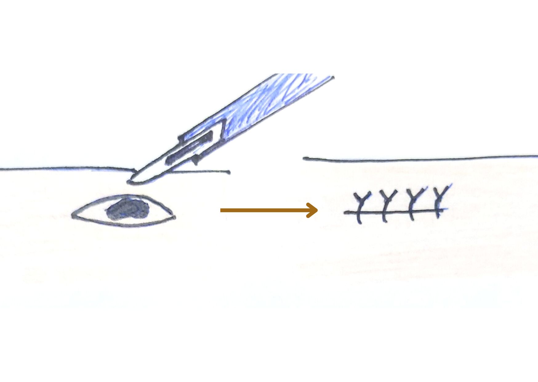 ¿Cómo se extirpan los lunares? - Dra. LOREA BAGAZGOITIA