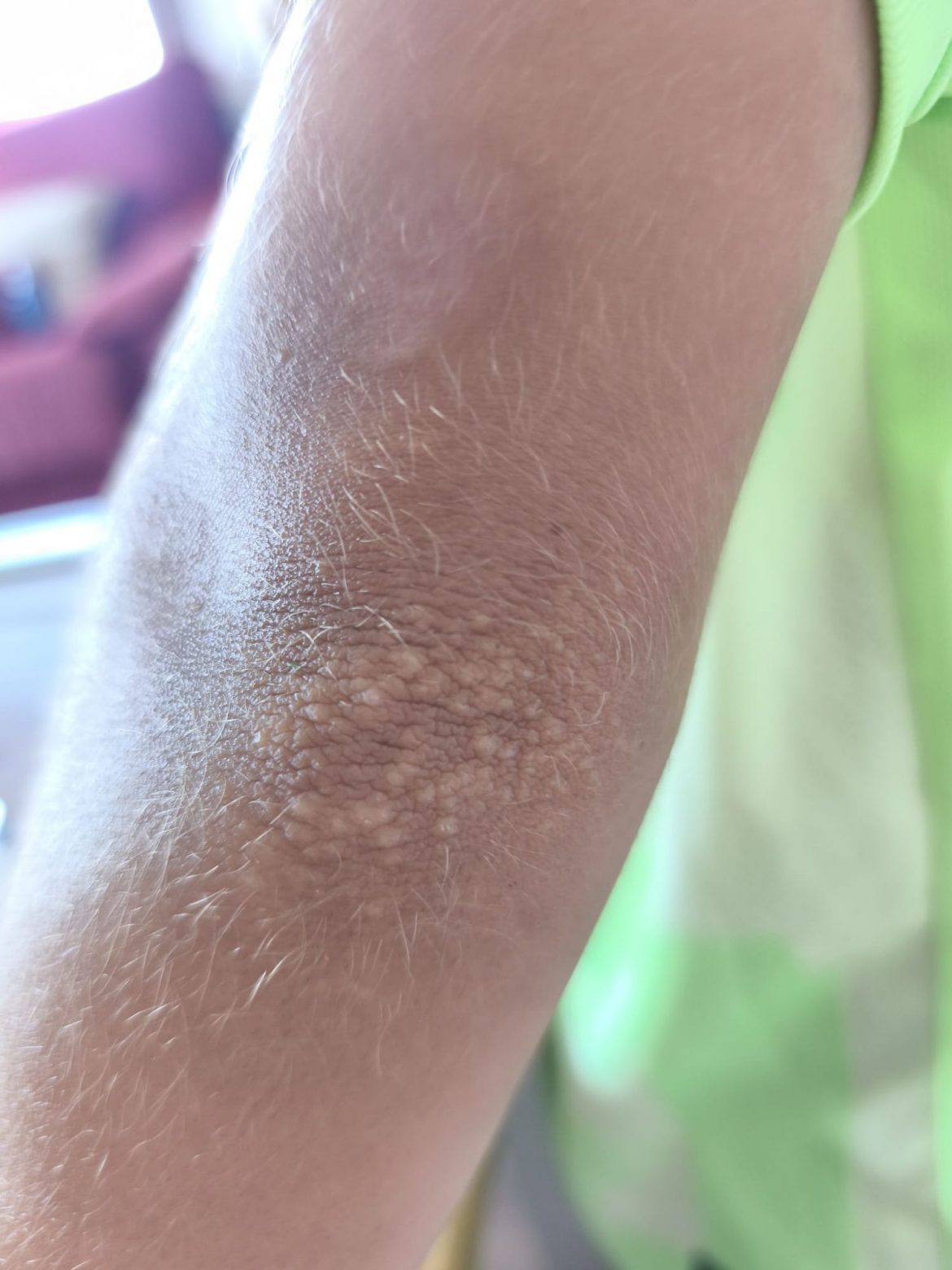 Small bumps on the hands, elbows, and feet: friction dermatitis - Dra ...
